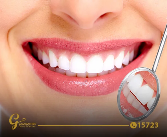 Teeth Whitening Egypt: Options and costs - الموقع الرسمي لعيادات ...